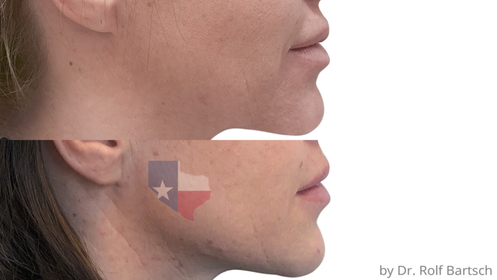 Texas Face | Jawline Contouring - TheAesthetics Dr. Rolf Bartsch & Dr ...
