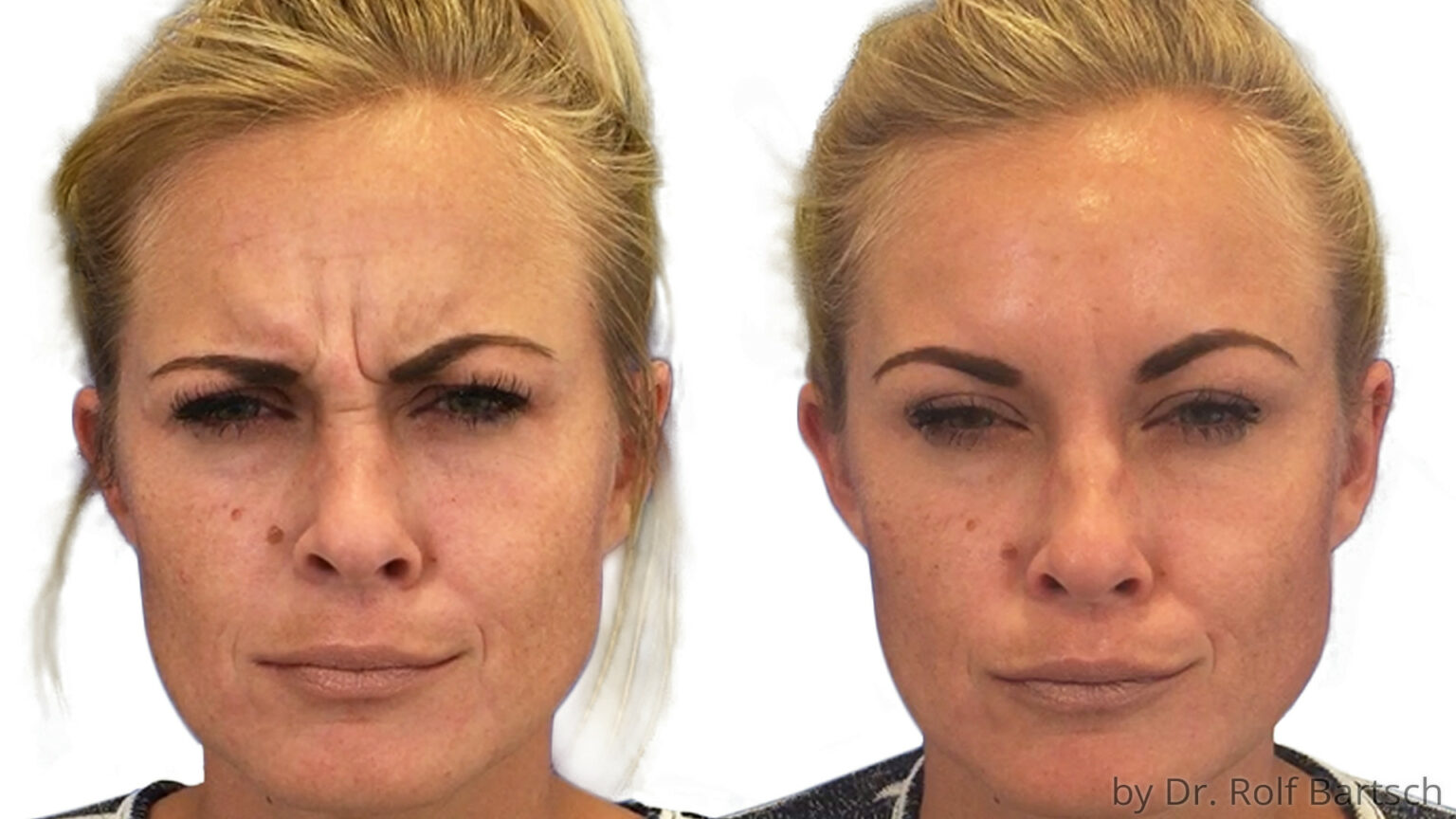 Botox® gegen Zornesfalten - TheAesthetics Dr. Rolf Bartsch & Dr. Katrin ...