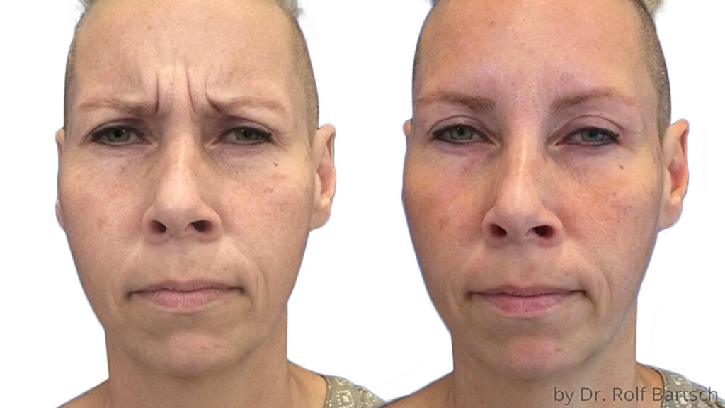 Botulinumtoxin / Botox - TheAesthetics Dr. Rolf Bartsch & Dr. Katrin ...