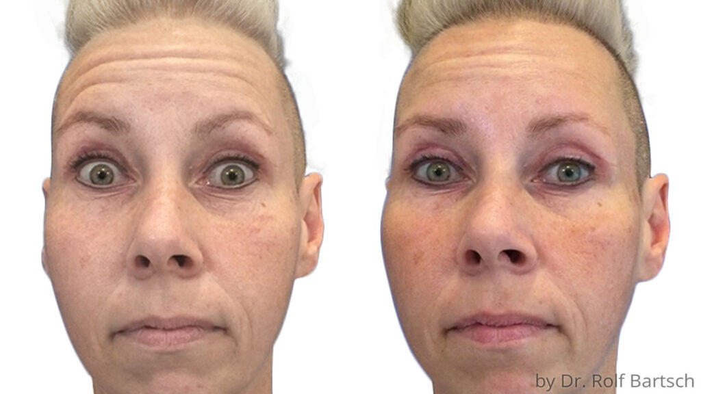 Botulinumtoxin / Botox - TheAesthetics Dr. Rolf Bartsch & Dr. Katrin ...
