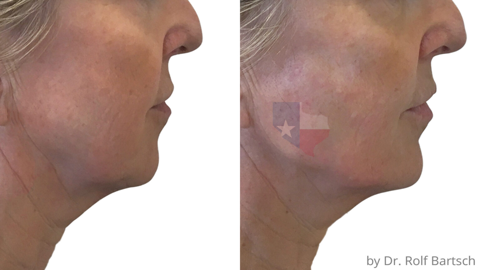 Texas Face | Jawline Contouring - TheAesthetics Dr. Rolf Bartsch & Dr ...