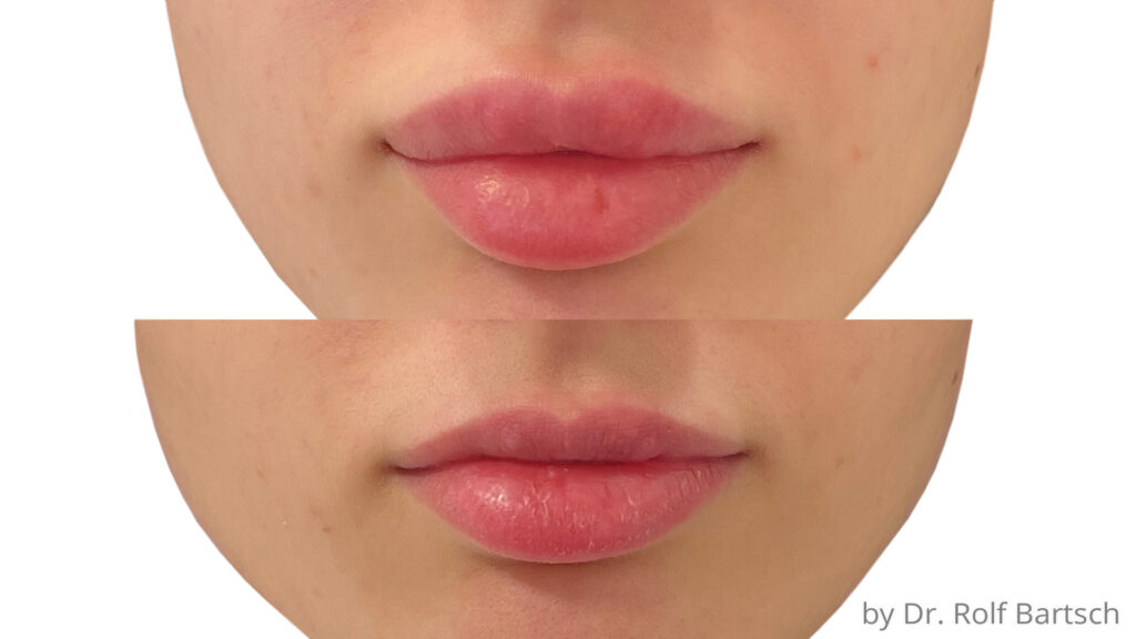 Hylase Archive - TheAesthetics Dr. Rolf Bartsch & Dr. Katrin Bartsch ...